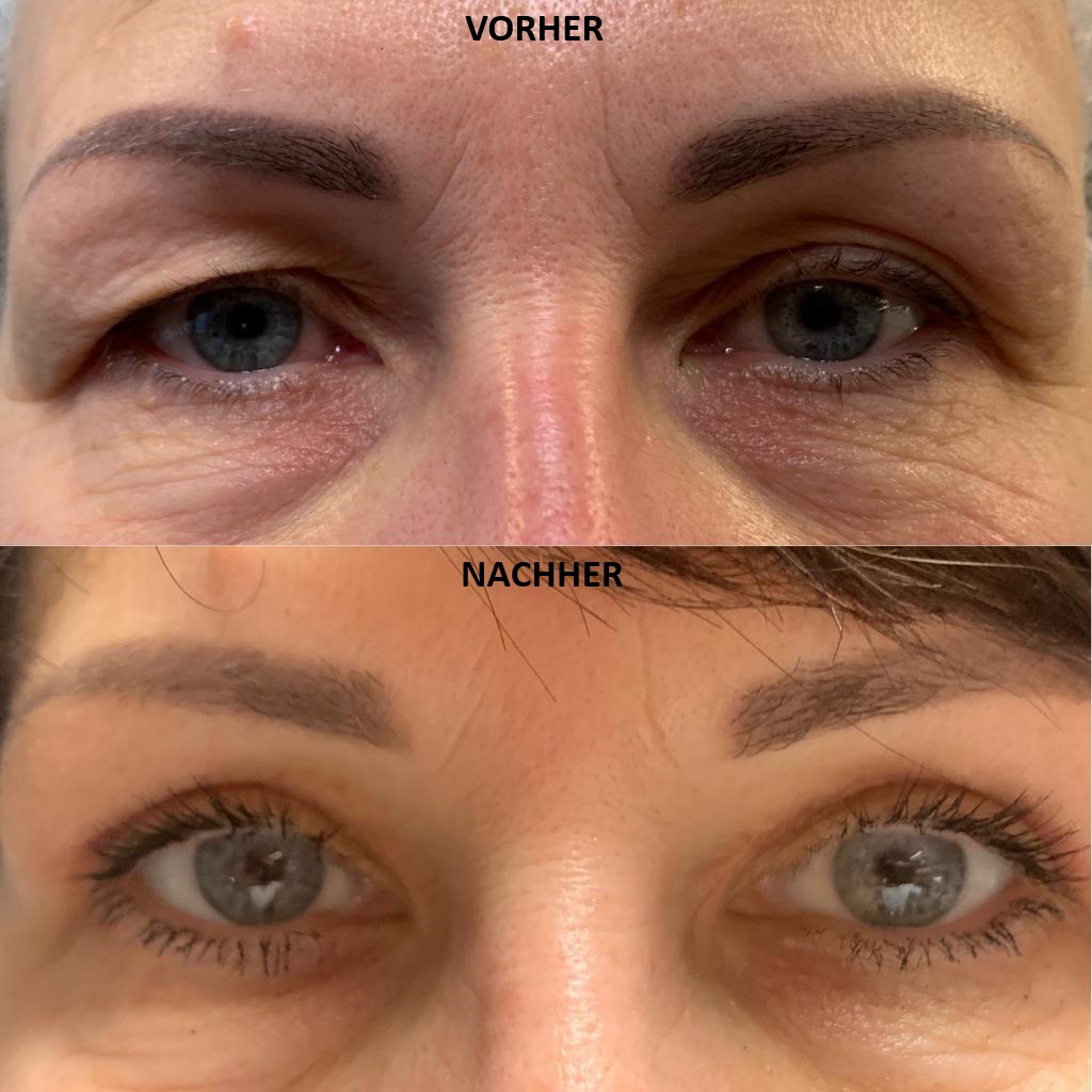 Lidoperationen – Augenarztpraxis Pforzheim – Dr. Med. Schuster & Saleh