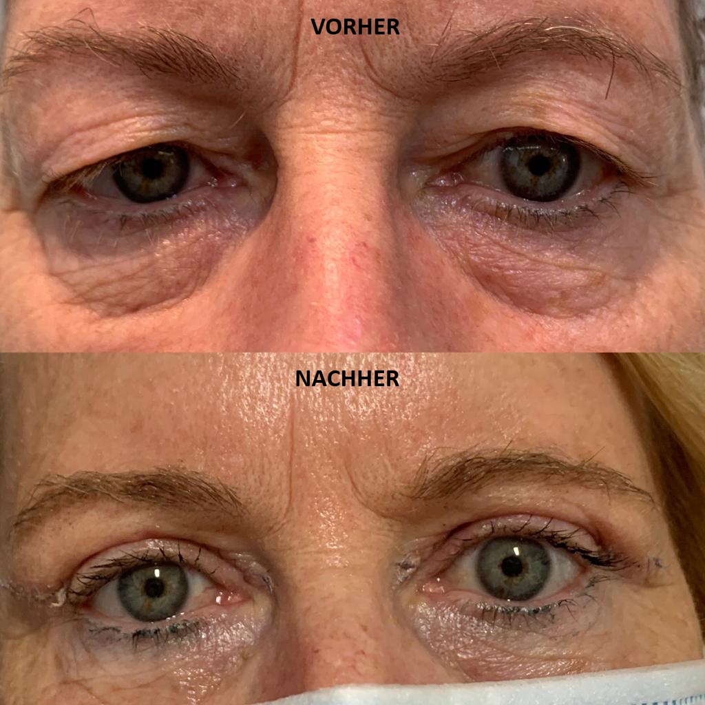 Lidoperationen – Augenarztpraxis Pforzheim – Dr. Med. Schuster & Saleh