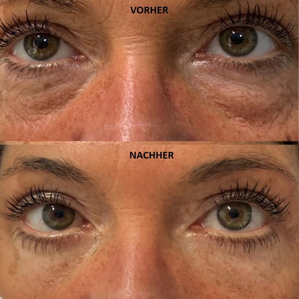 Lidoperationen – Augenarztpraxis Pforzheim – Dr. Med. Schuster & Saleh